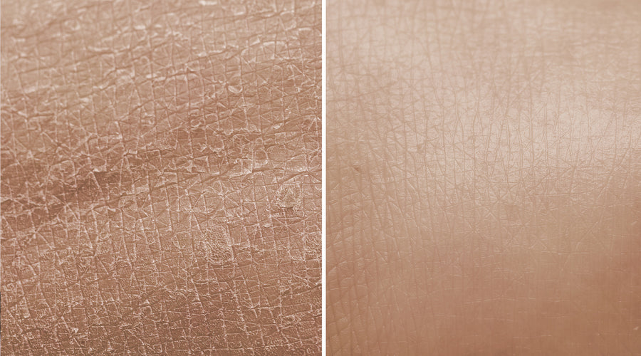 Dry Skin Vs Dehydrated Skin - Stratia