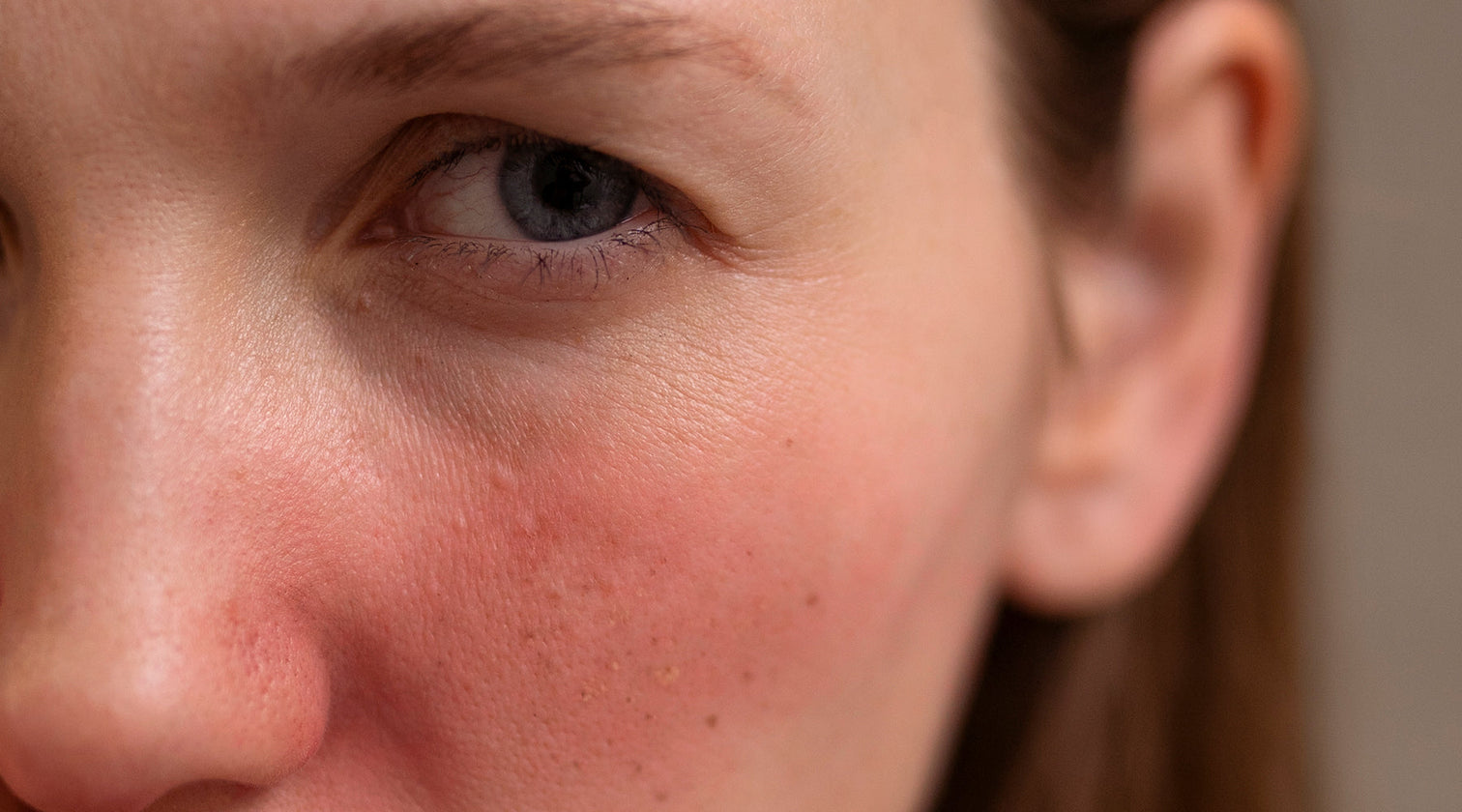 Inflammation: The Invisible Culprit Behind Your Skin Issues - Stratia