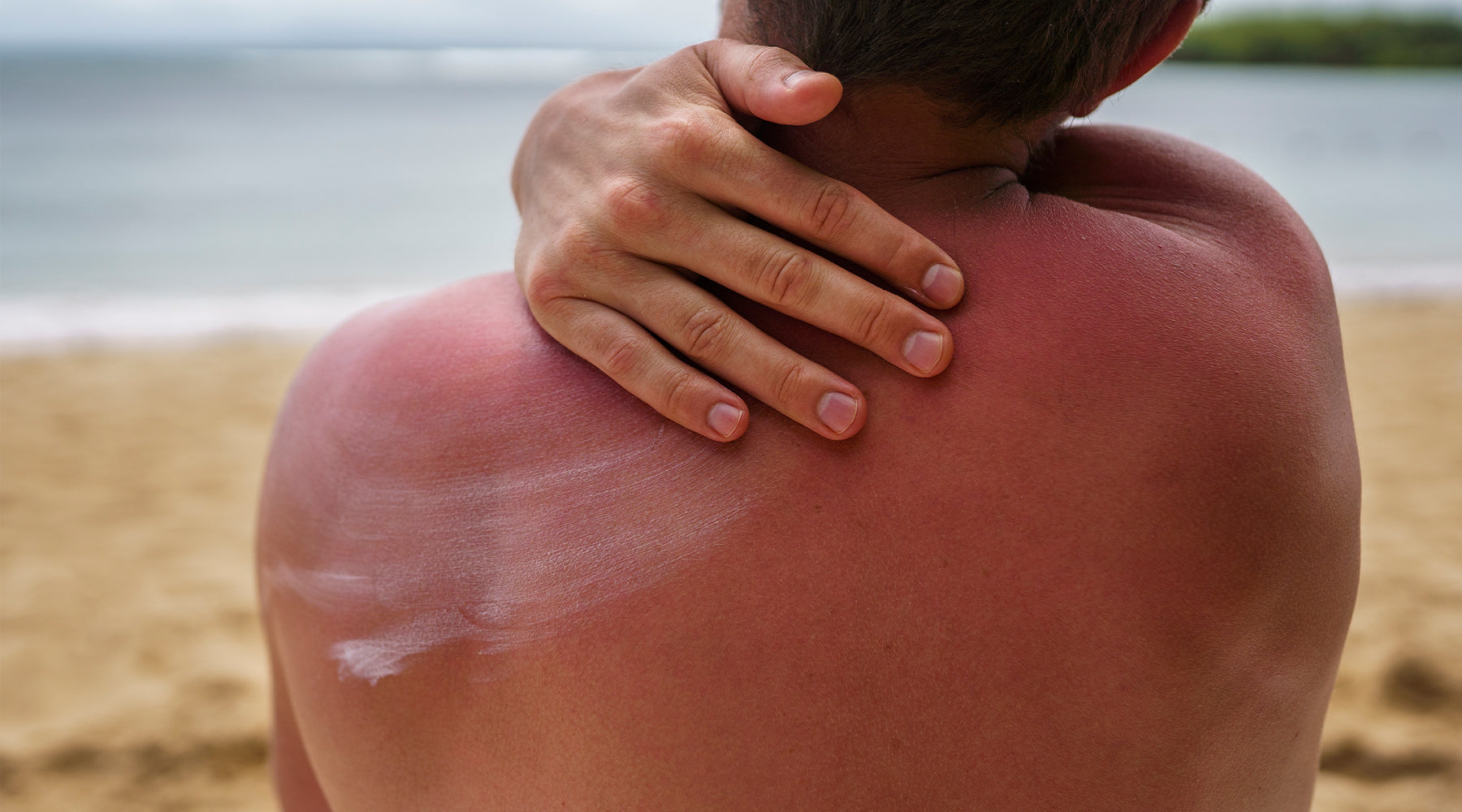 What Is a Sunburn? Unraveling the Science Behind Skin Damage and Preve ...